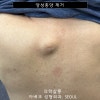 재발 표피낭종 제거 수술 등에 생긴 혹이 불편합니다【dr 아베크 양성종양】 네이버 블로그